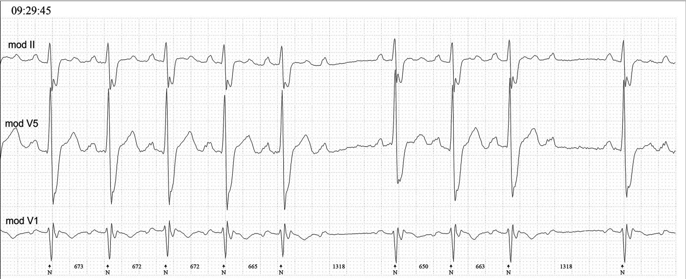 Second degree AVB Mobitz Type II | ECG Guru - Instructor Resources Second degree AVB Mobitz Type II | ECG Guru - Instructor Resources